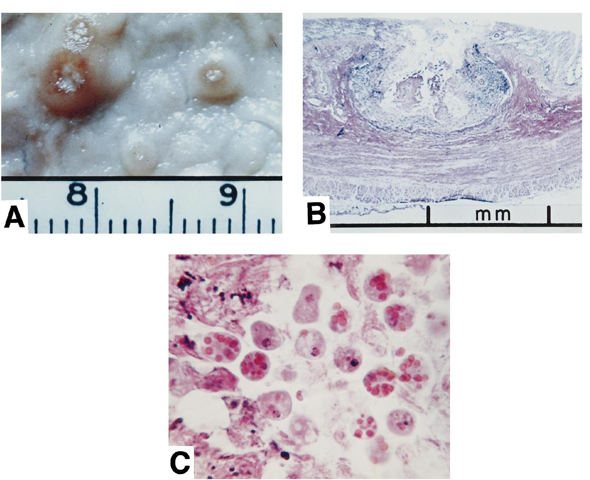 Figure 2 - from Diagnosis and Management of Amebiasis