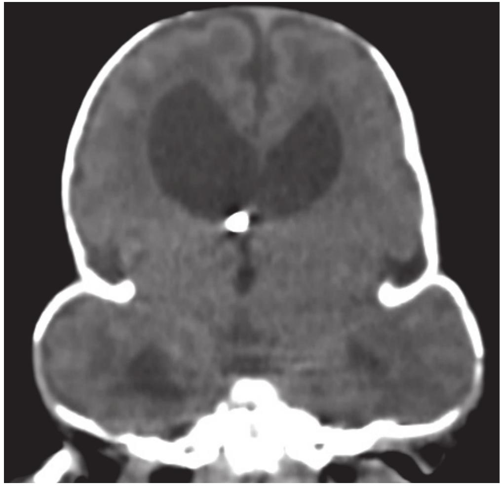 Cloverleaf skull sign. coronal ct image of infant with