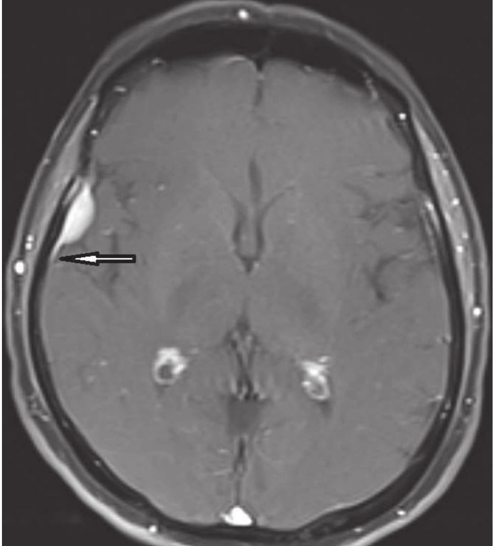 Dural tail. transverse mri image shows dural “tail” of