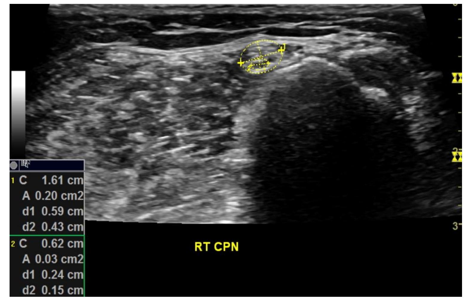 Shows slightly swollen nerve with swollen nerve fasicle with