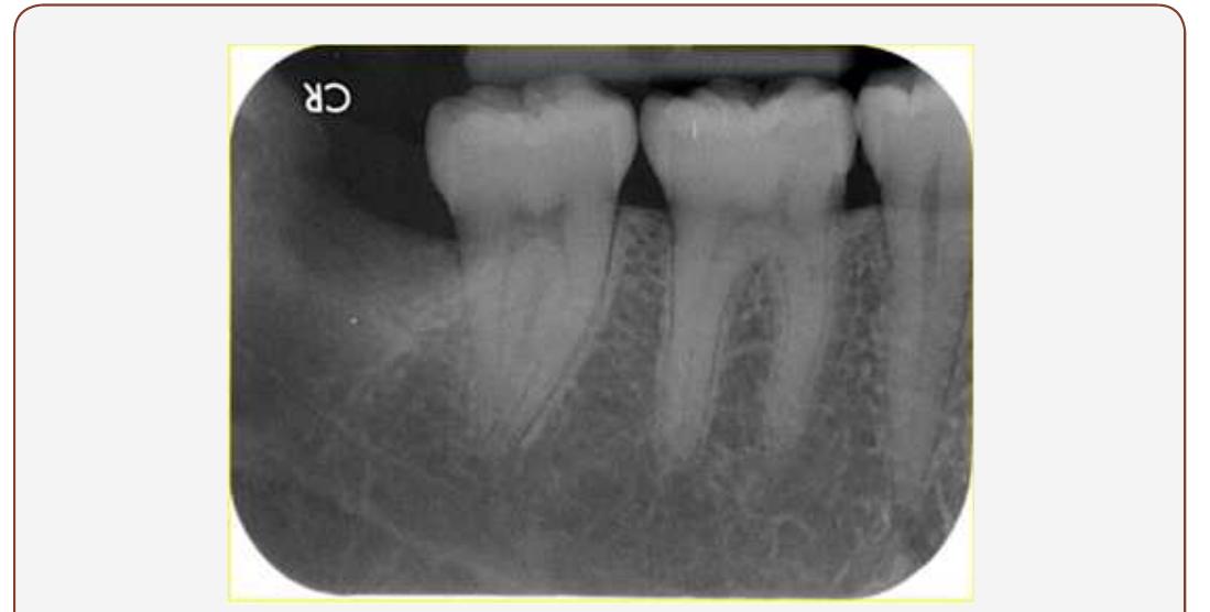 Figure 6 - Dissecting Subperiosteal Abscess After Surgical