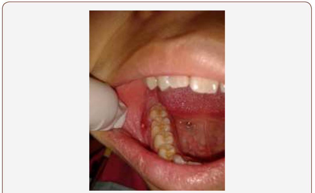Figure 14 - Dissecting Subperiosteal Abscess After Surgical