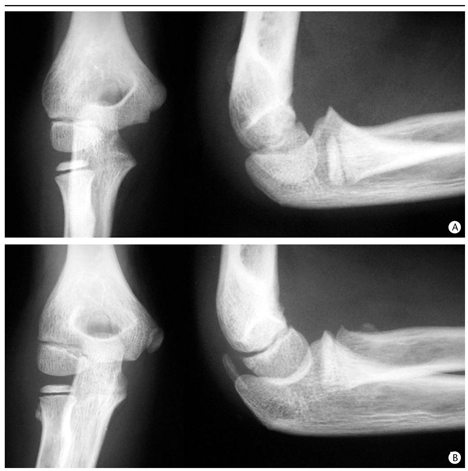 5 calcification of the annular ligament and tricipital