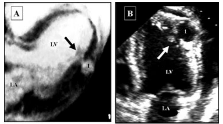Figure 5 - Intramyocardial Dissecting Hematoma and