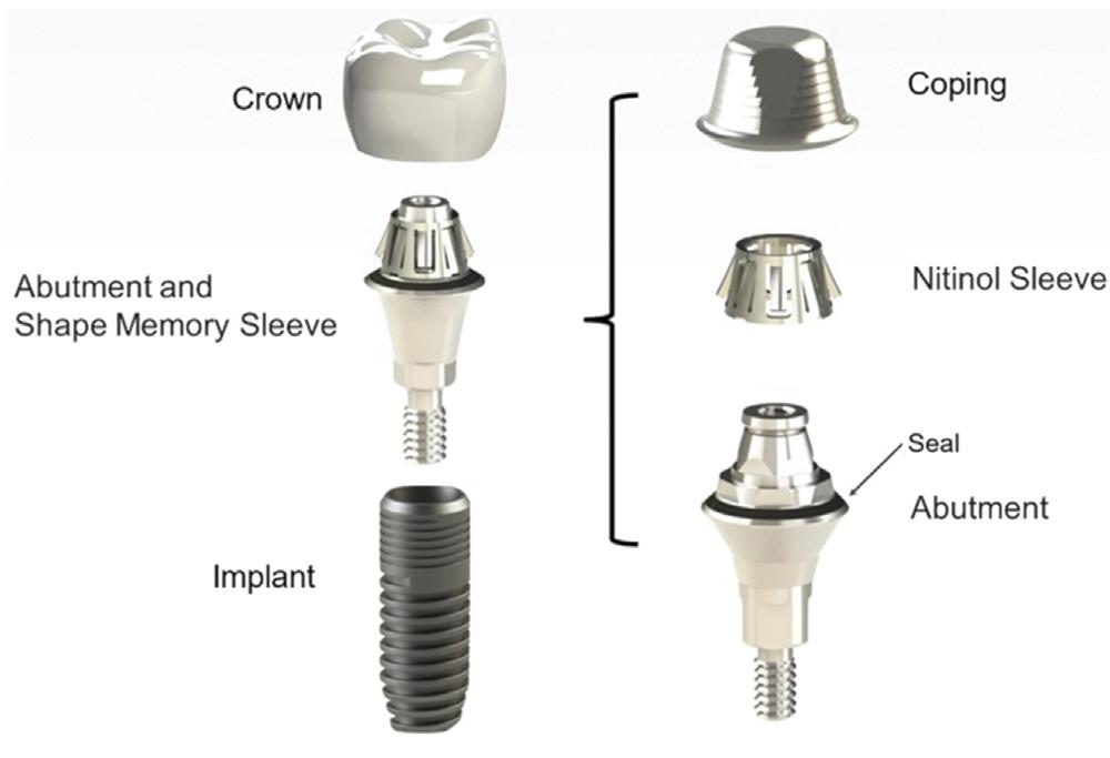 Shape-memory abutment system. table 1.lmplant position and