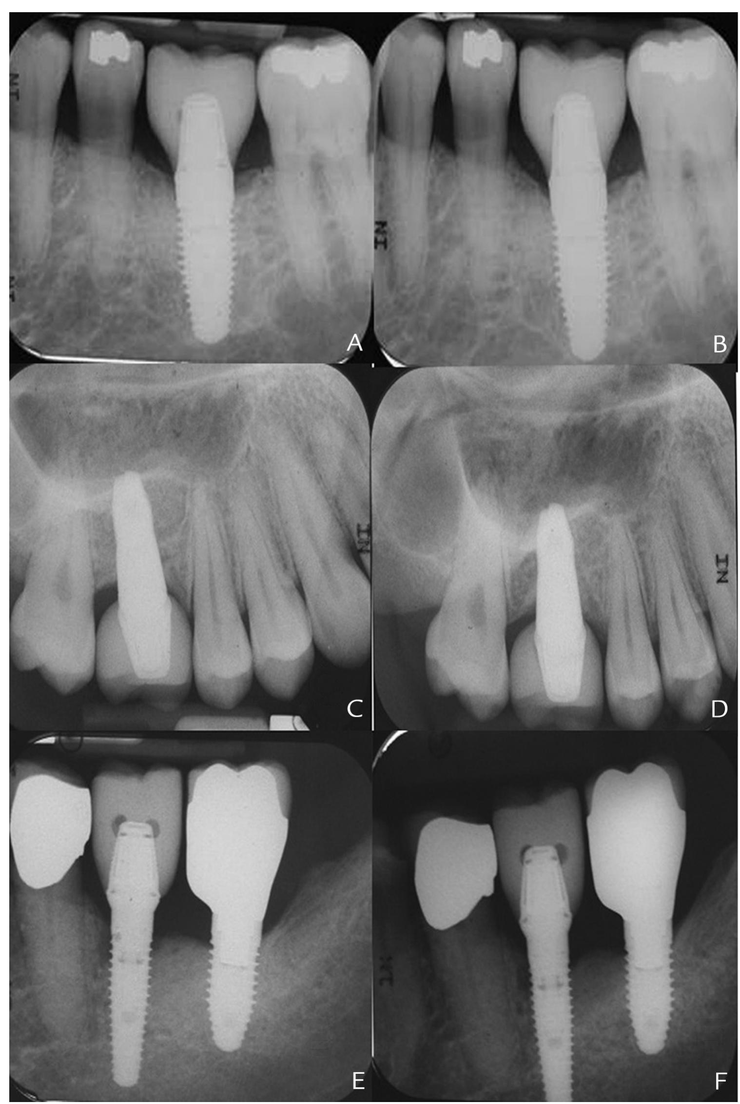 Representative radiographs of implant-supported restorations