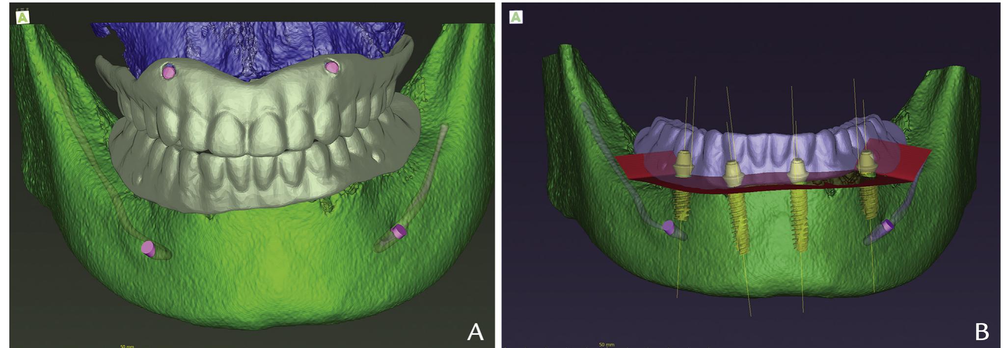 Figure 4 - from Treating an edentulous mandible with an