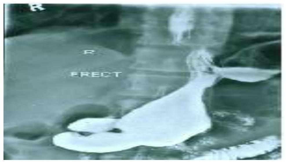 Barium swallow showing spilling of barium from fundal sac