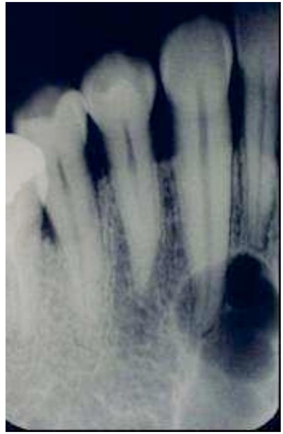 Periapical radiograph showing the multilocular aspect. after