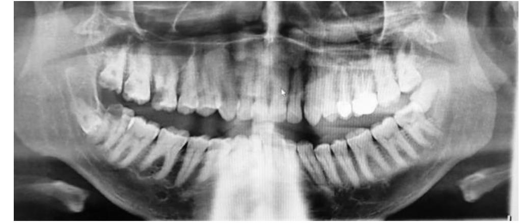 Bilateral impacted mandibular distomolars a 42-year-old male