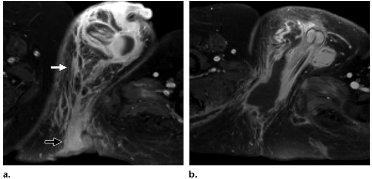 Penile-scrotal abscess with cutaneous fistula in a
