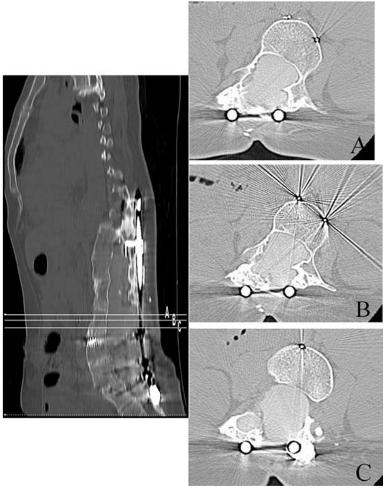 (a-c) sagittal reconstruction image of thoracolumbar spine.