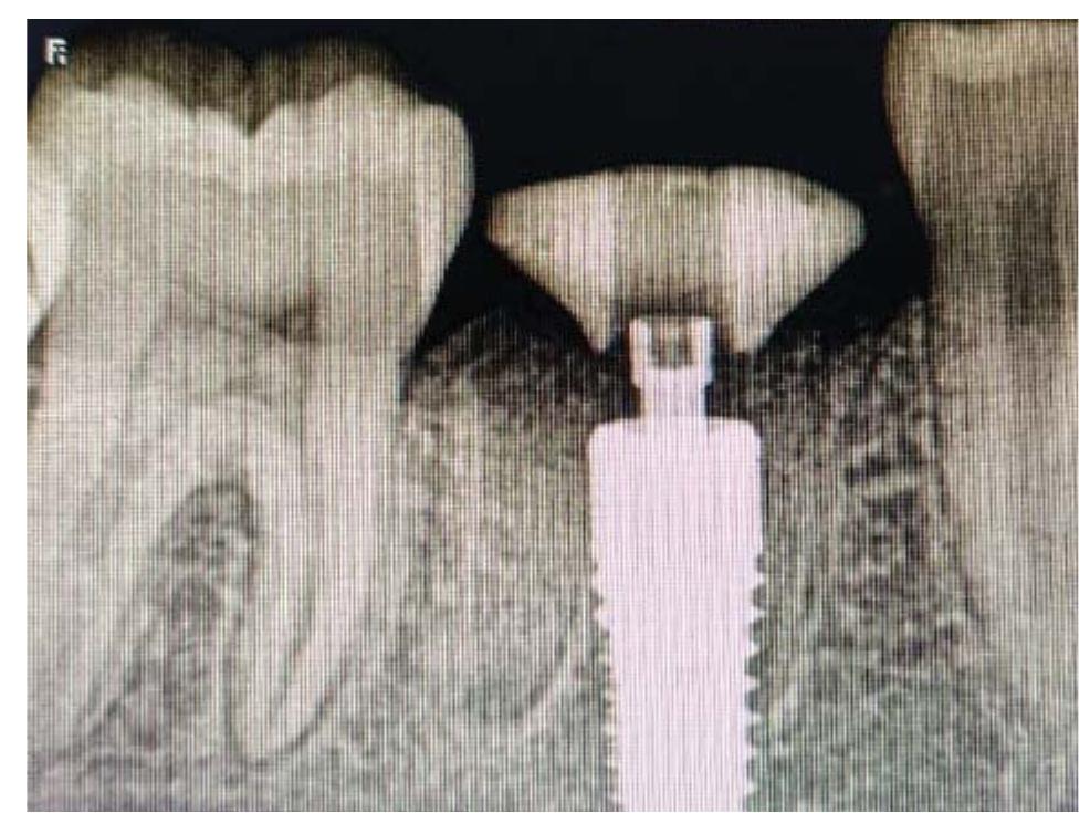 Radiograph after placement of gingival former figure 6