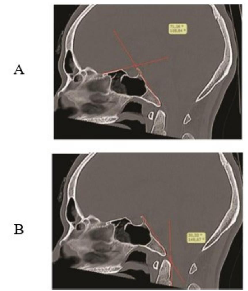 A: angle of the skull base, b: angle of clivus posterior