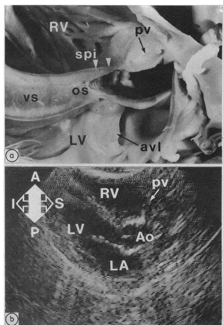 (a) photograph of anormal heart that represents a long axis