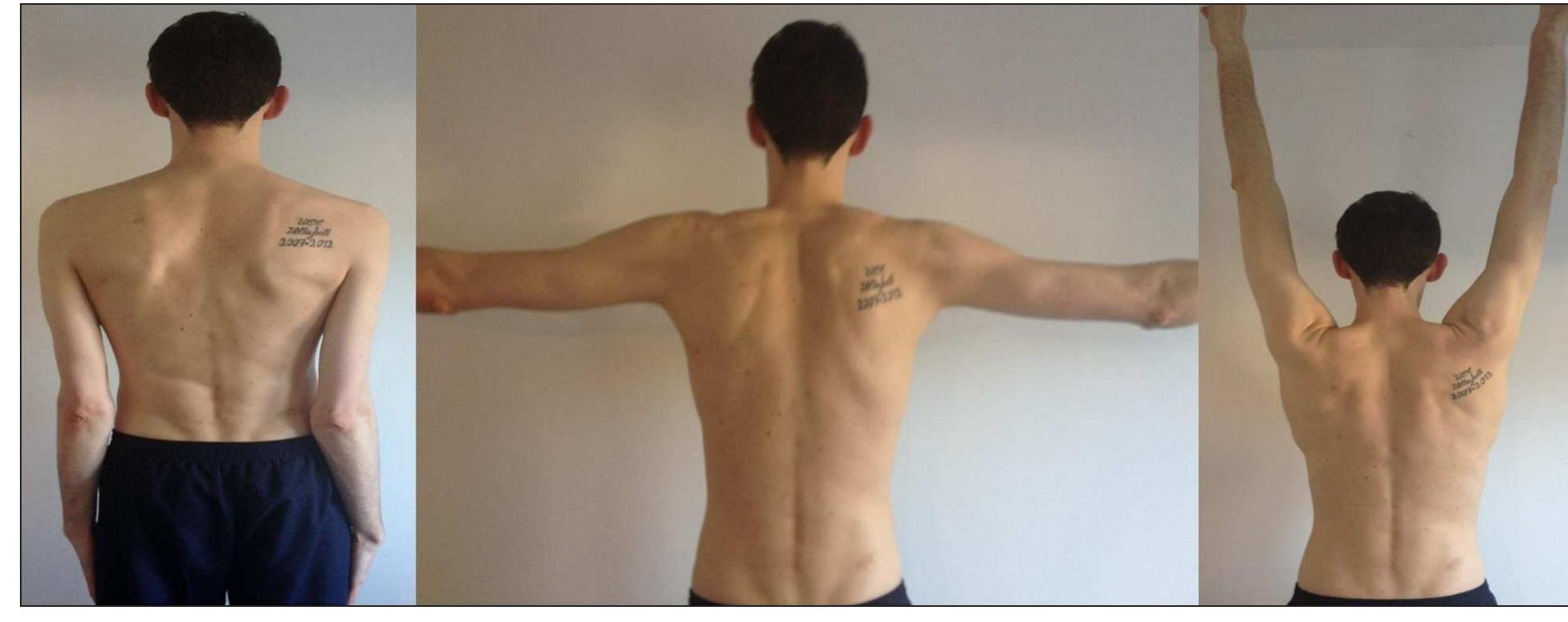 the scapular-control test. the scapular-control test was