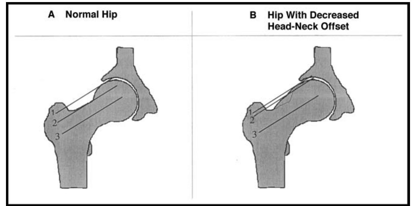 Em femoral head-neck offset. this offset represents the