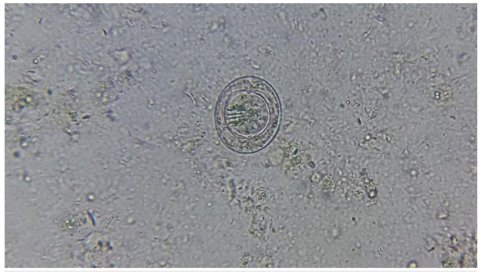 -igure 1: direct stool wet mount showing non-bile stainec gg