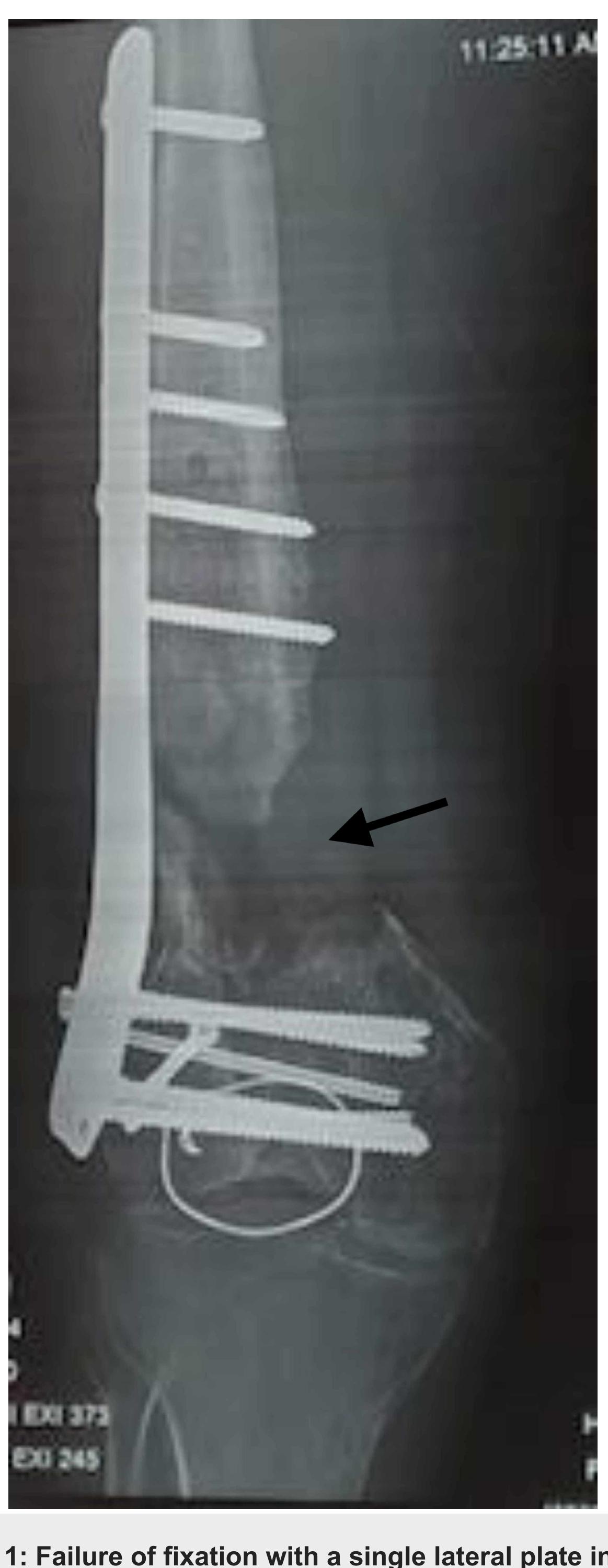 Figure 1 - Dual Plating of the Distal Femur: Indications and