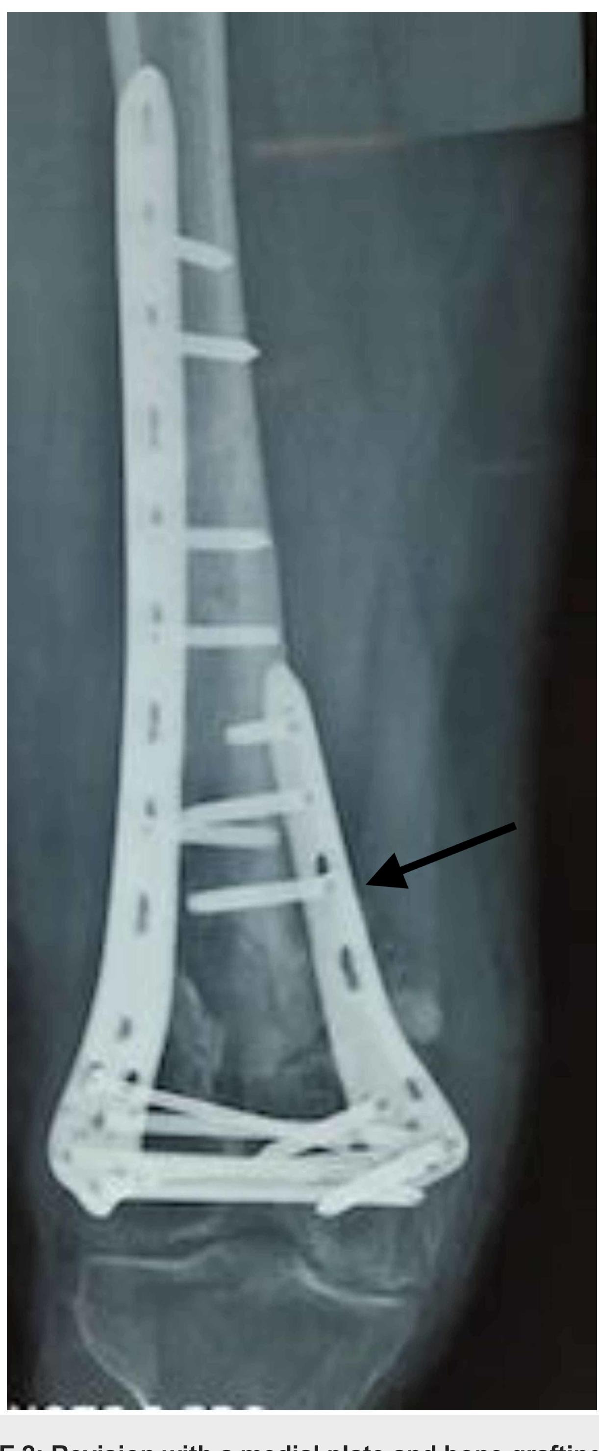 Figure 2 - Dual Plating of the Distal Femur: Indications and