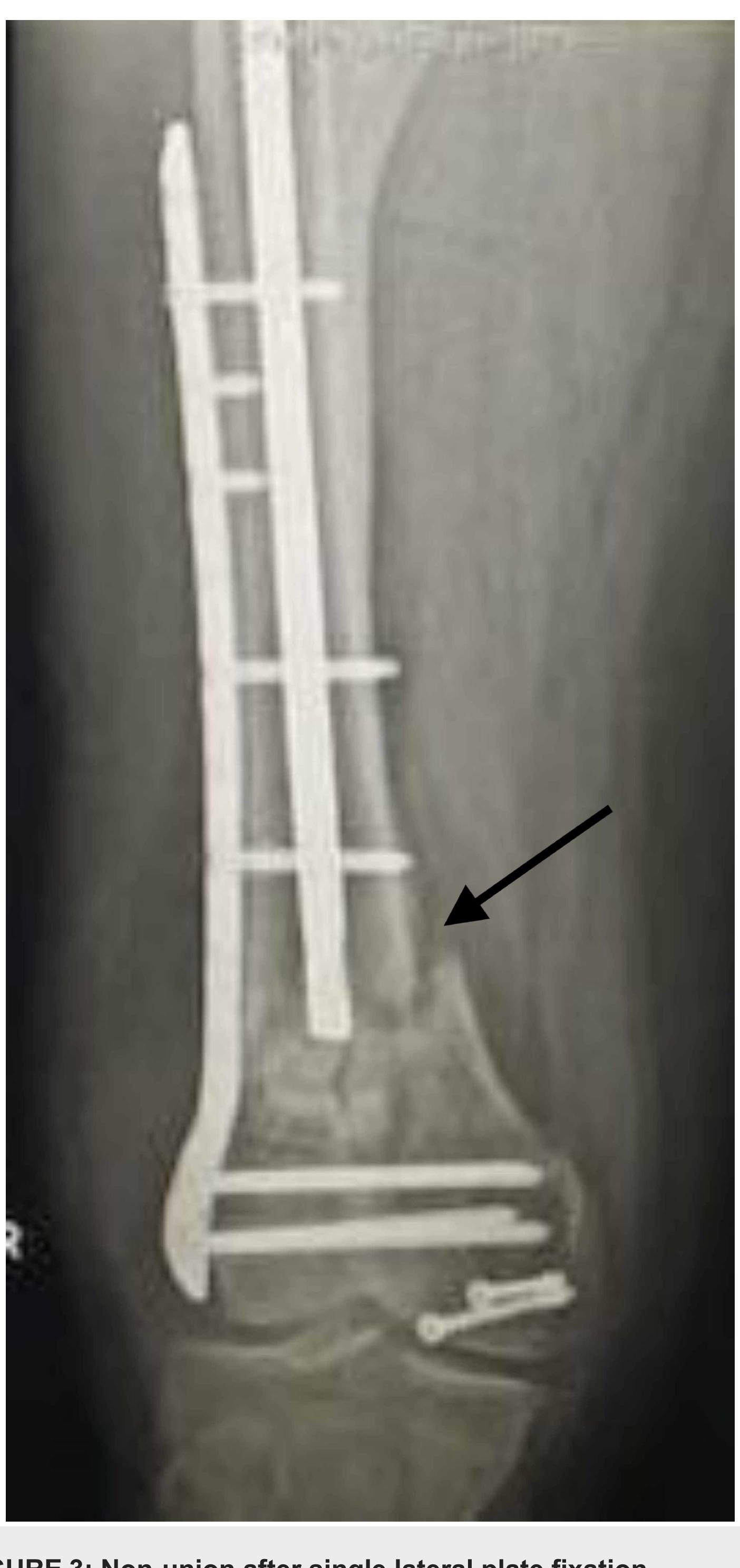 Figure 3 - Dual Plating of the Distal Femur: Indications and