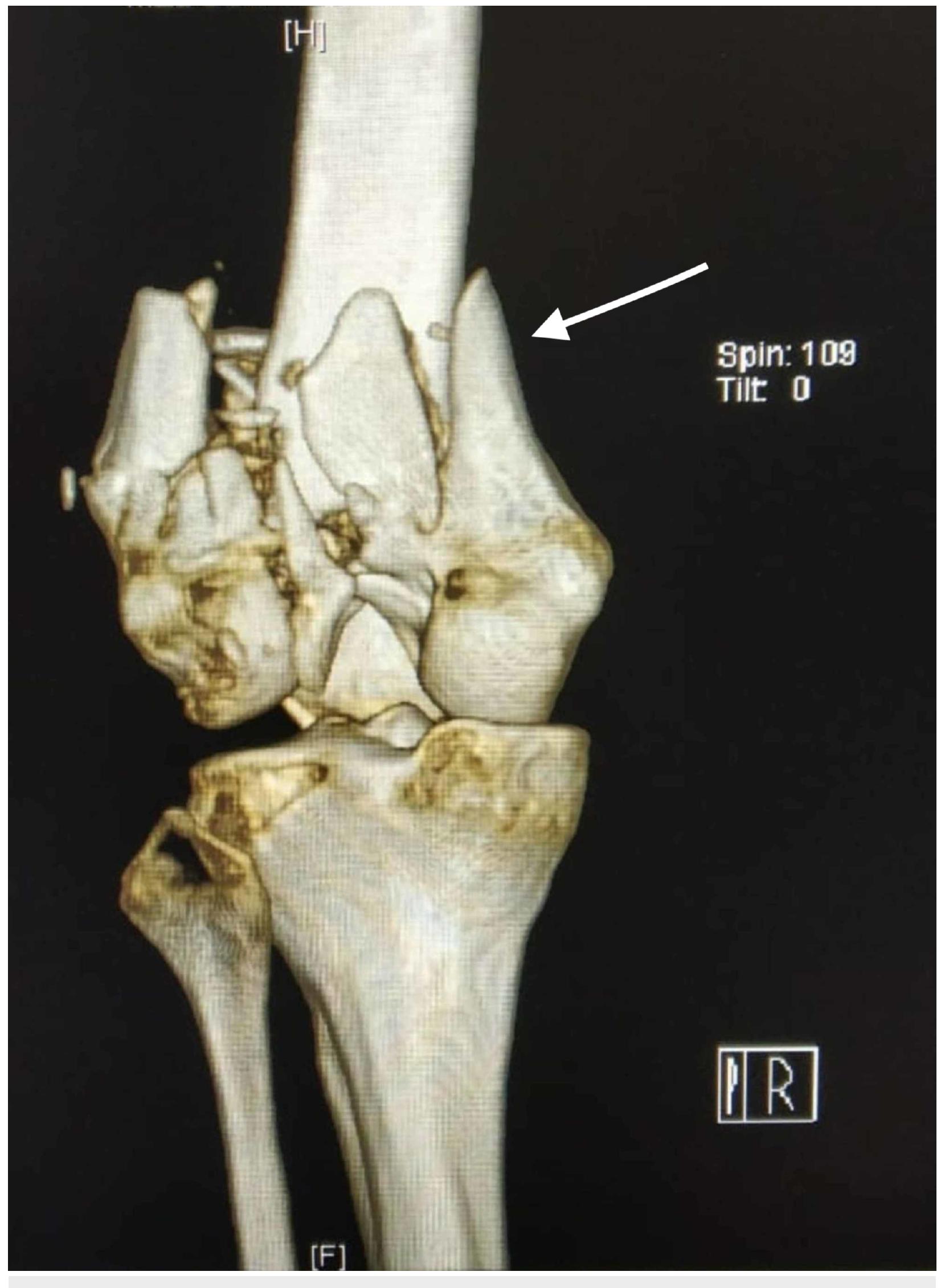 3d ct image showing a comminuted distal femur fracture in a