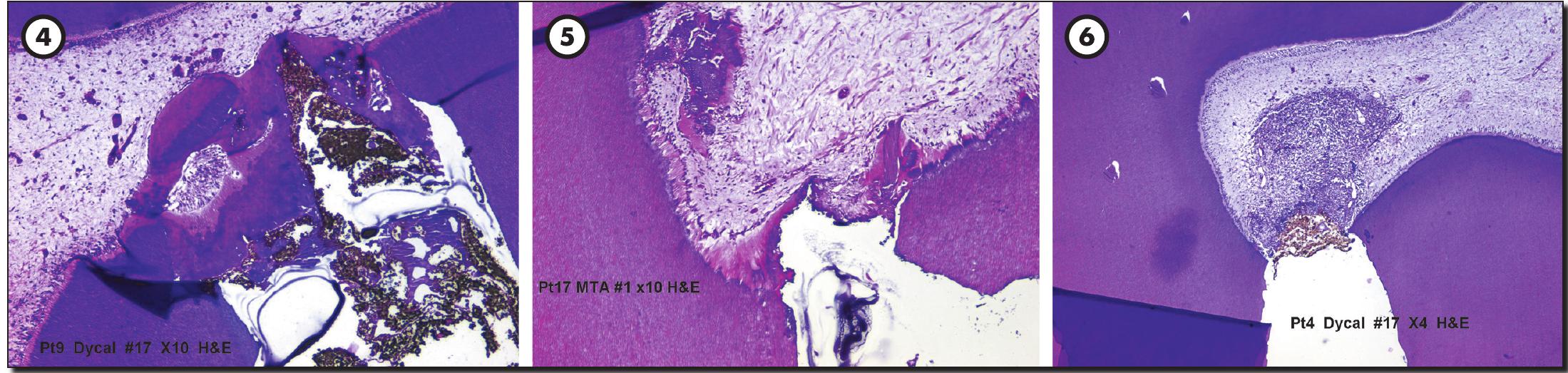 Tortuous bridge after pulp capping with dycal containing