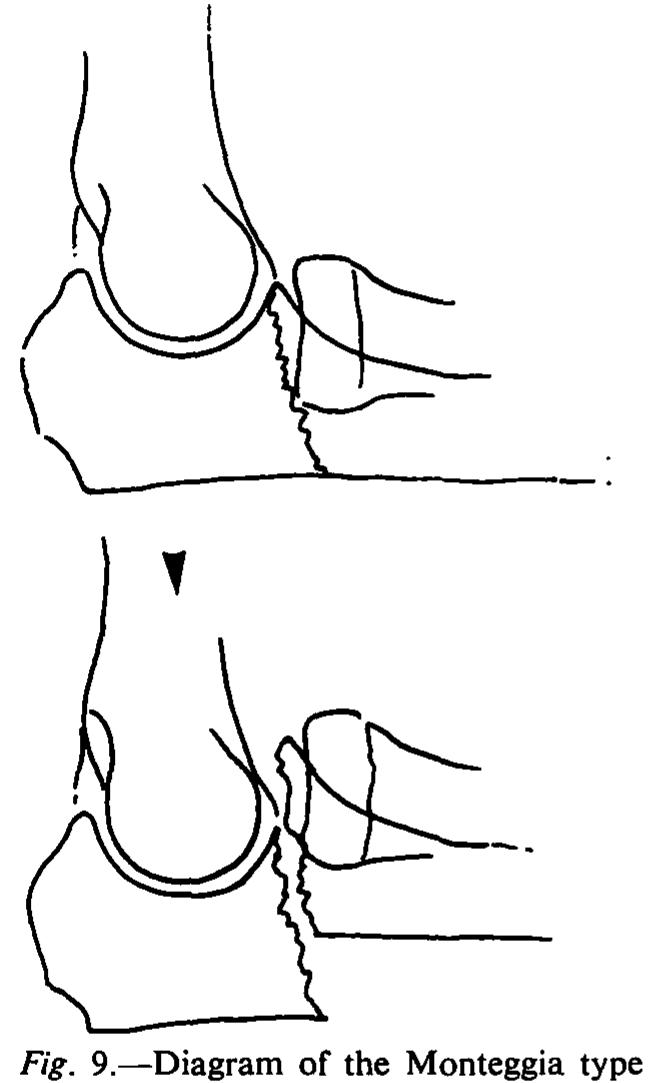 Figure 8 - Fractures of the olecranon in adults: