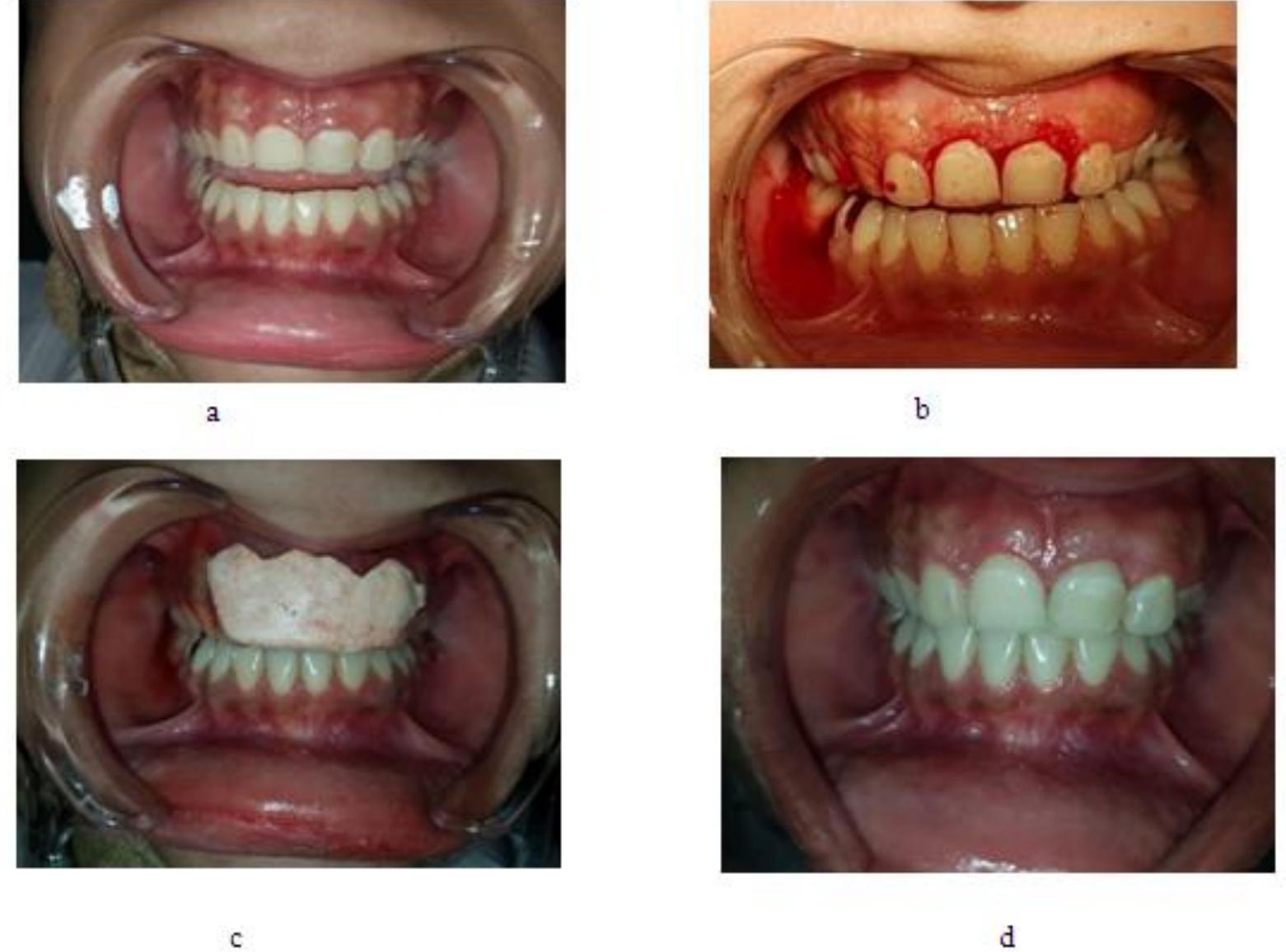 No.4:localized gingivectomy by scalpel for upper left and