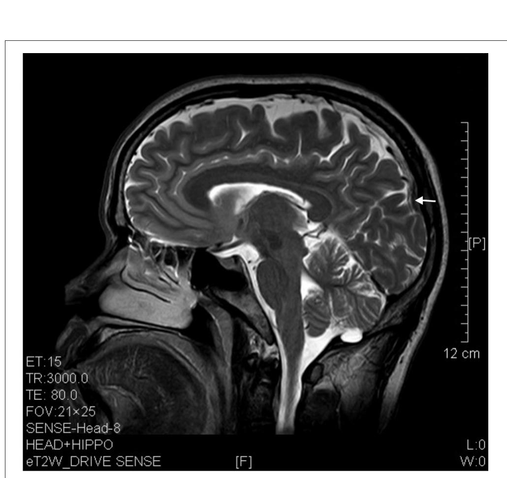| t2 image showed parietal atrophy (arrow) in a sagittal