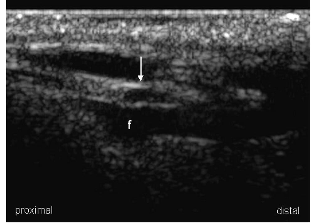 Fic. 7. ultrasound image of abductor pollicis longus