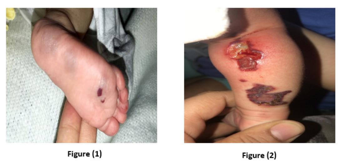 ,2: history of small papule skin lesion in right lower limb