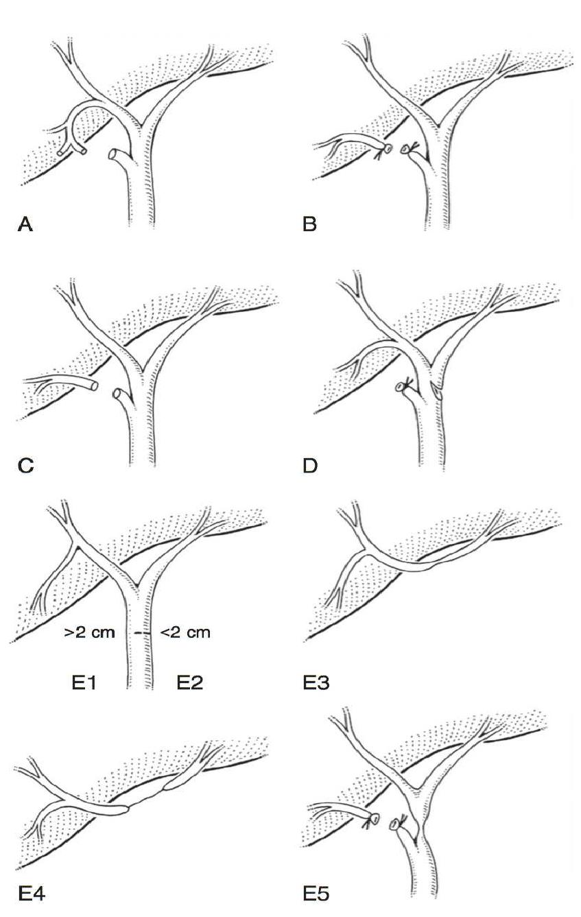 Bismuth-strasberg classification of bile duct injury a. bile