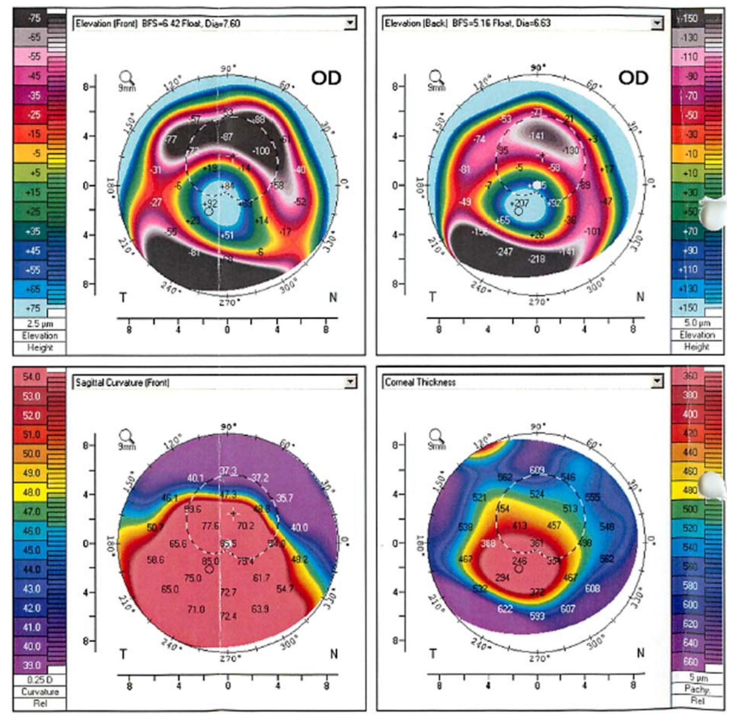 Pentacam corneal topography post-intacs procedure (right eye