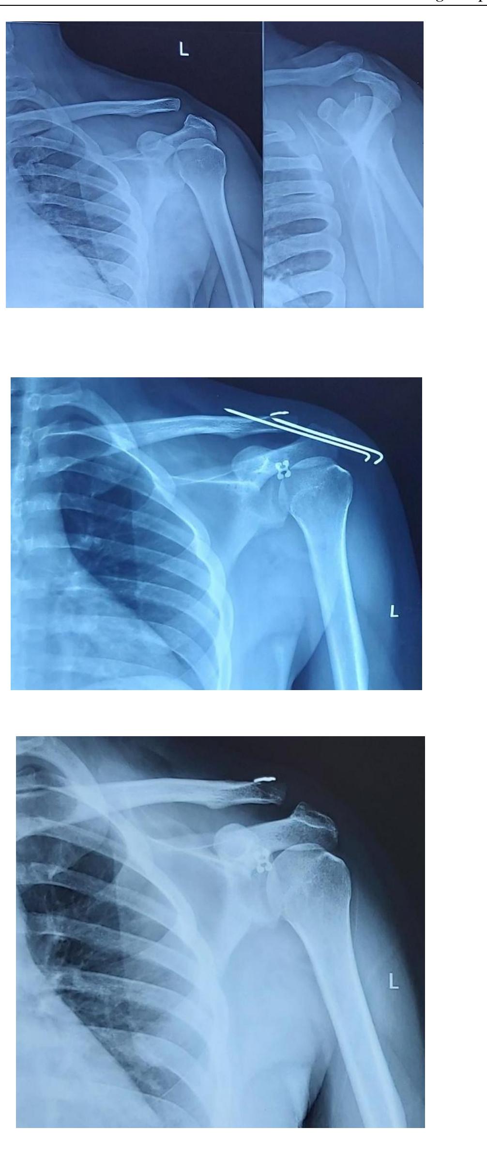 Figure 1 - from Tightrope Fixation for Acromioclavicular