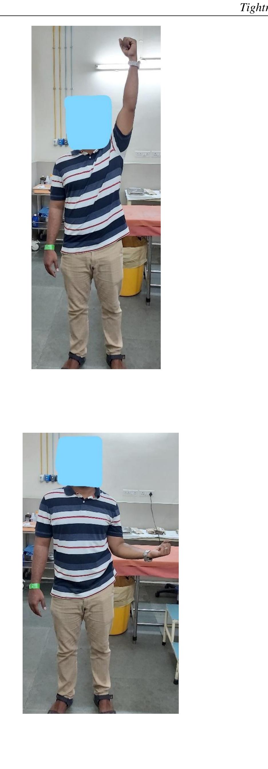 Figure 2 - Tightrope Fixation for Acromioclavicular Joint