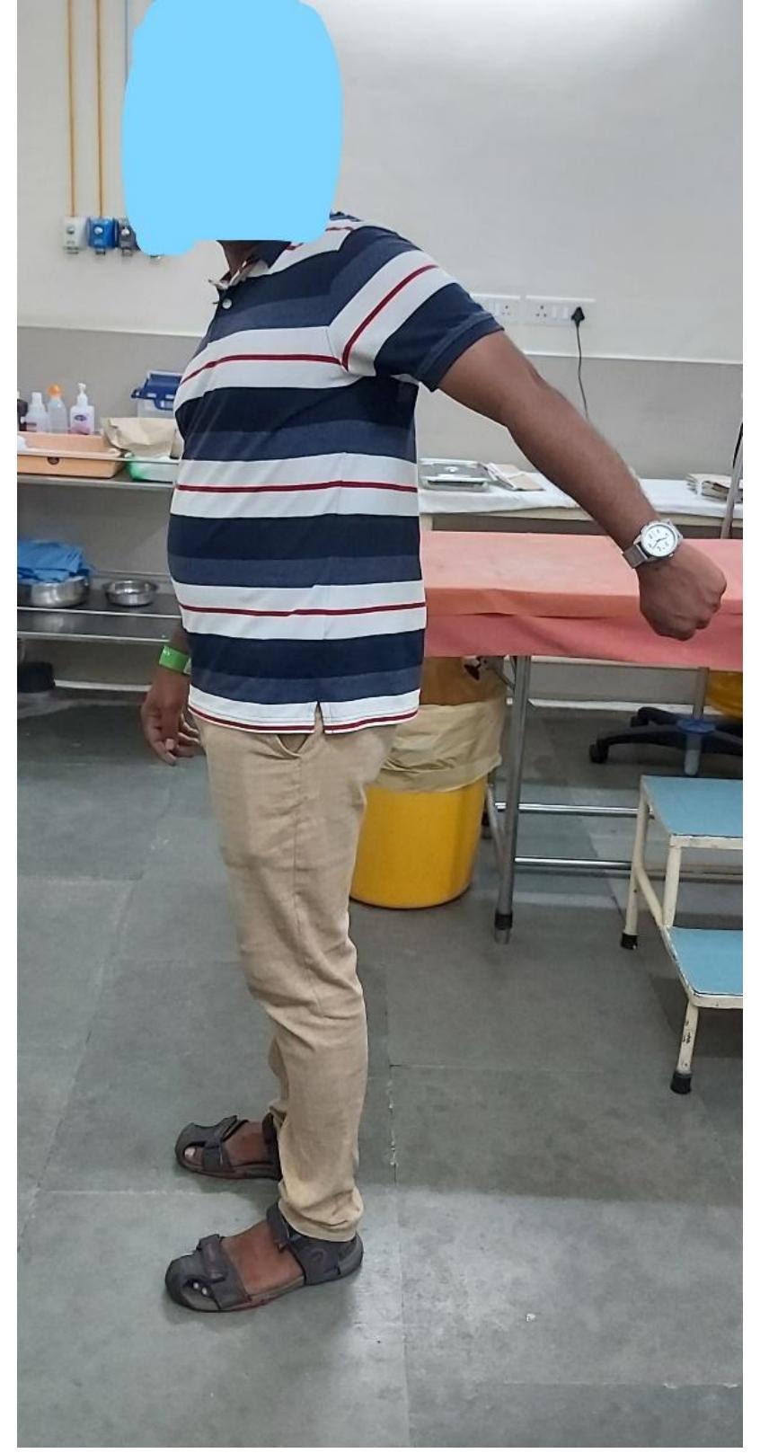 Figure 4 - Tightrope Fixation for Acromioclavicular Joint