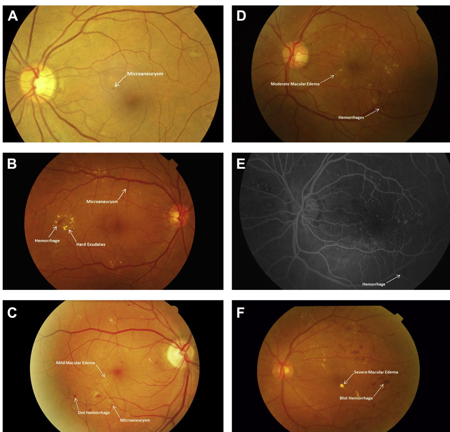 Fundus photographs and fluorescein angiogram showing