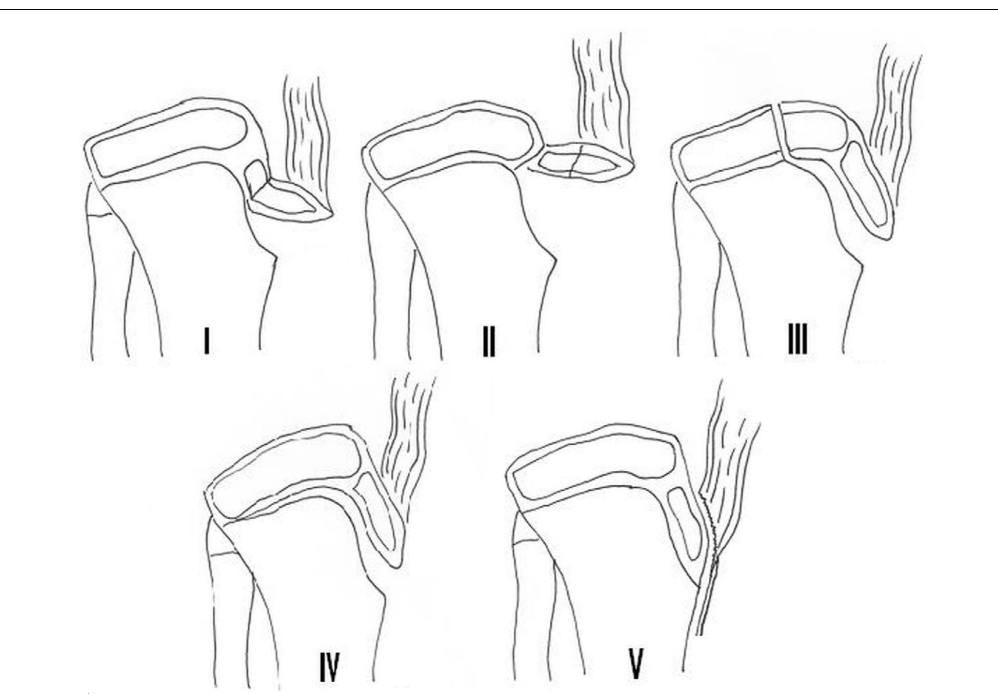 Classification of tibial tuberosity fractures. the journal