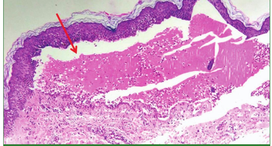 [table/fig-6]: subepidermal bulla with neutrophils in