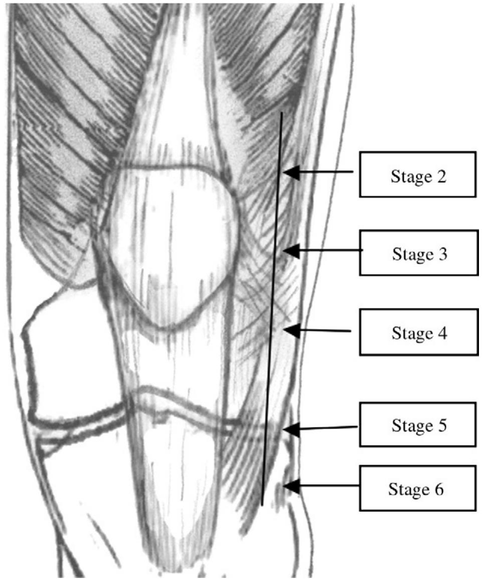 Schematic diagram of staged lateral release. seventy-six