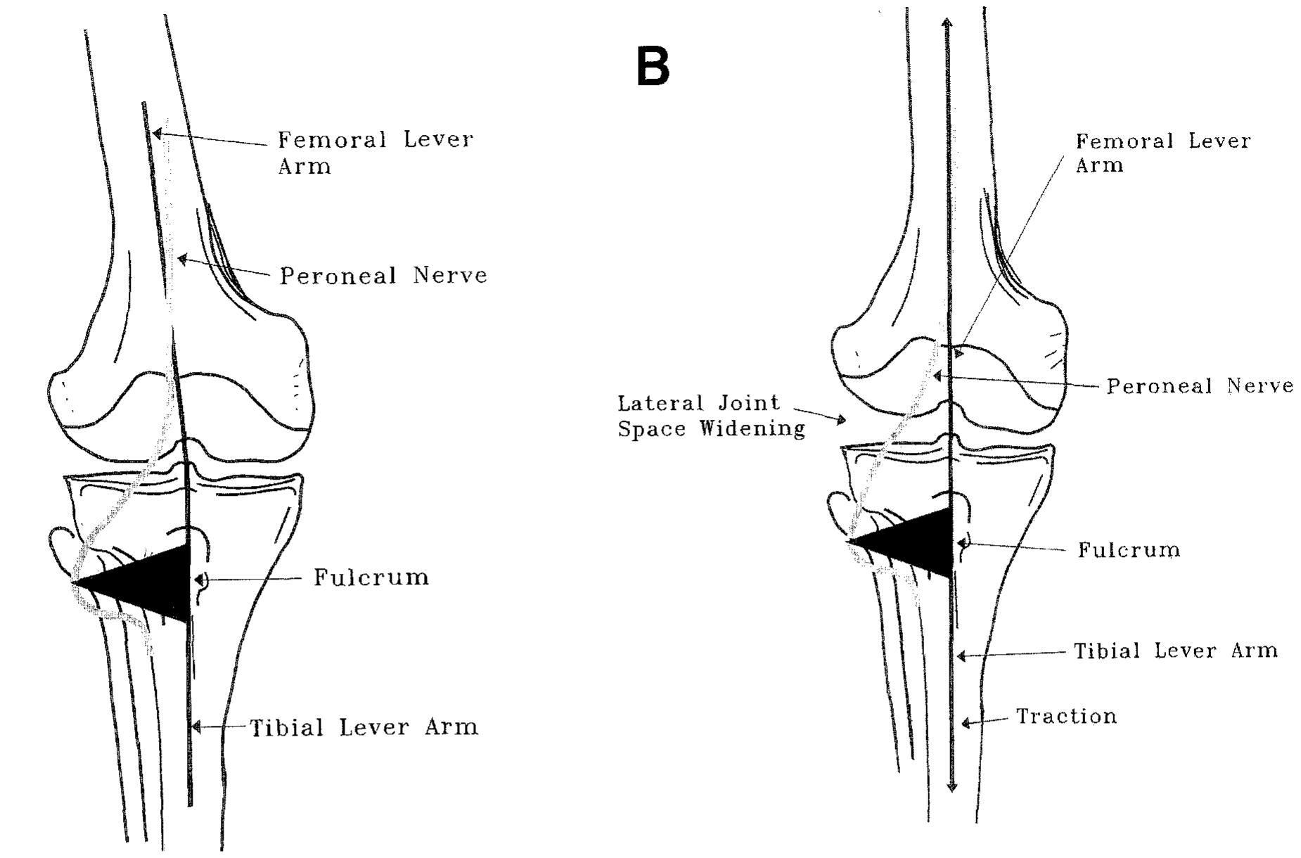(a) surrounding bony anatomy about the peroneal nerve. (b)