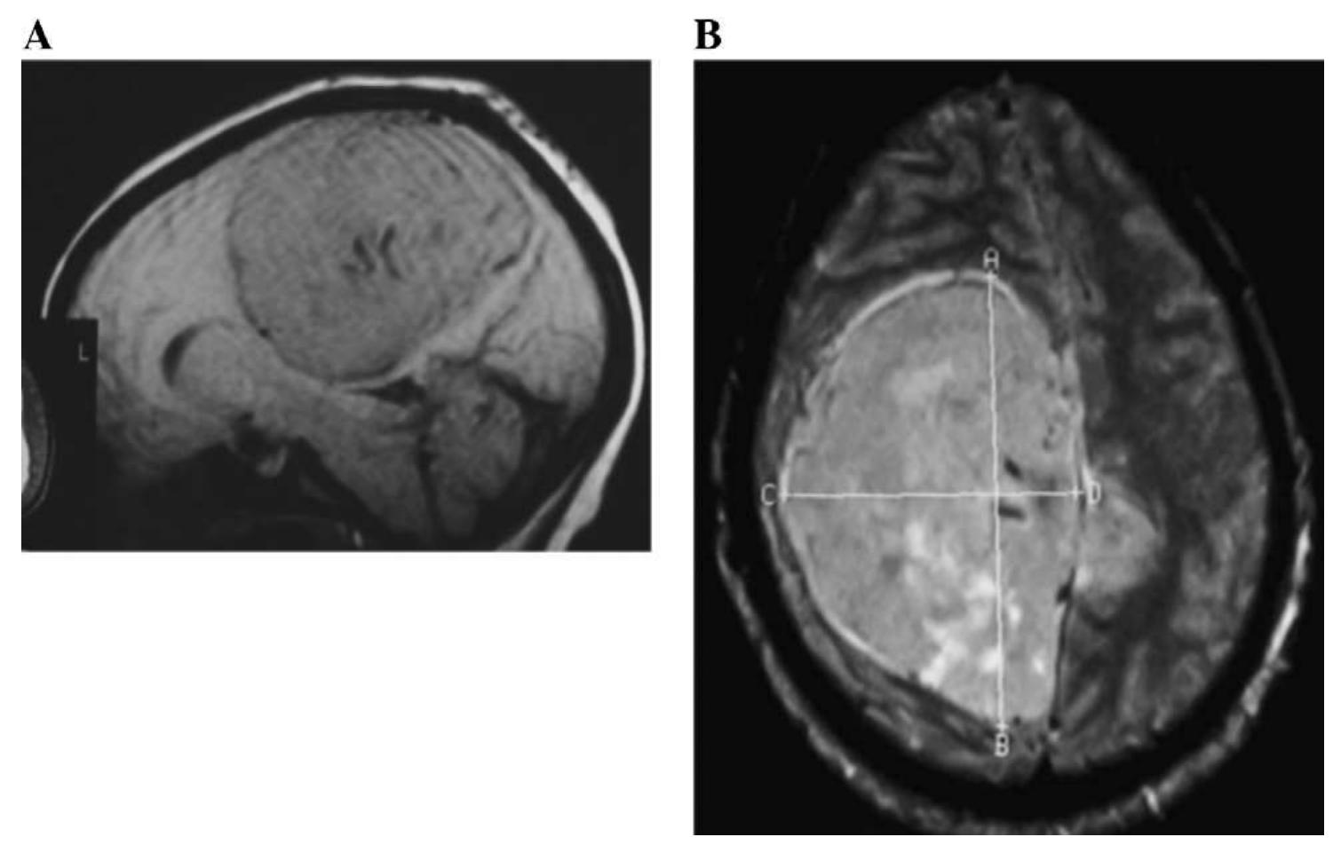 (a) mri ti sagittal and (b) t2 axial images of an