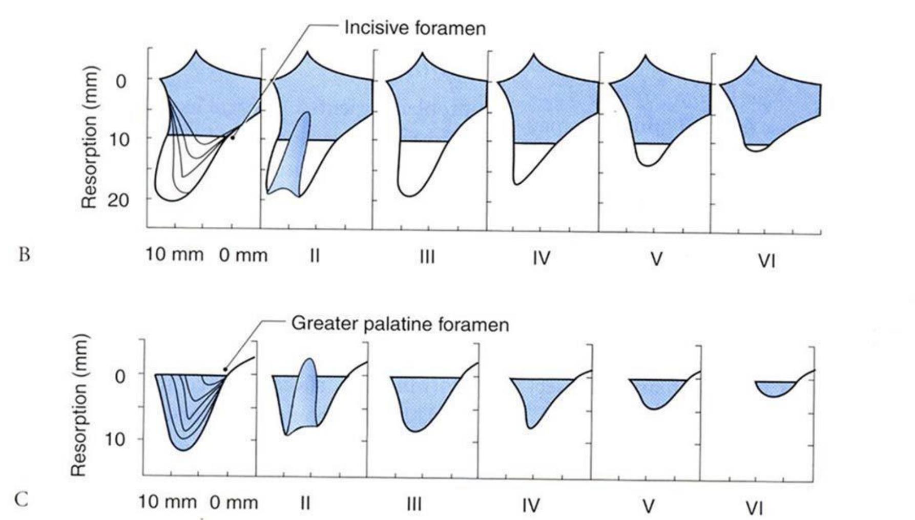 Maxillary horizontal measurements (a). classification of