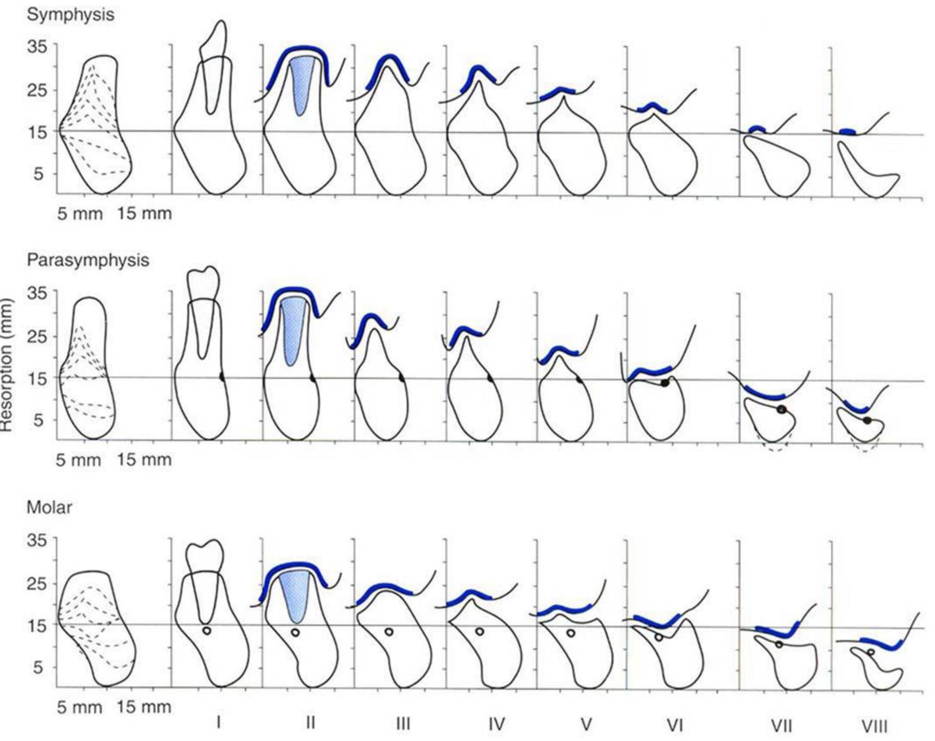 Modified cawood and howell classification of resorption. the