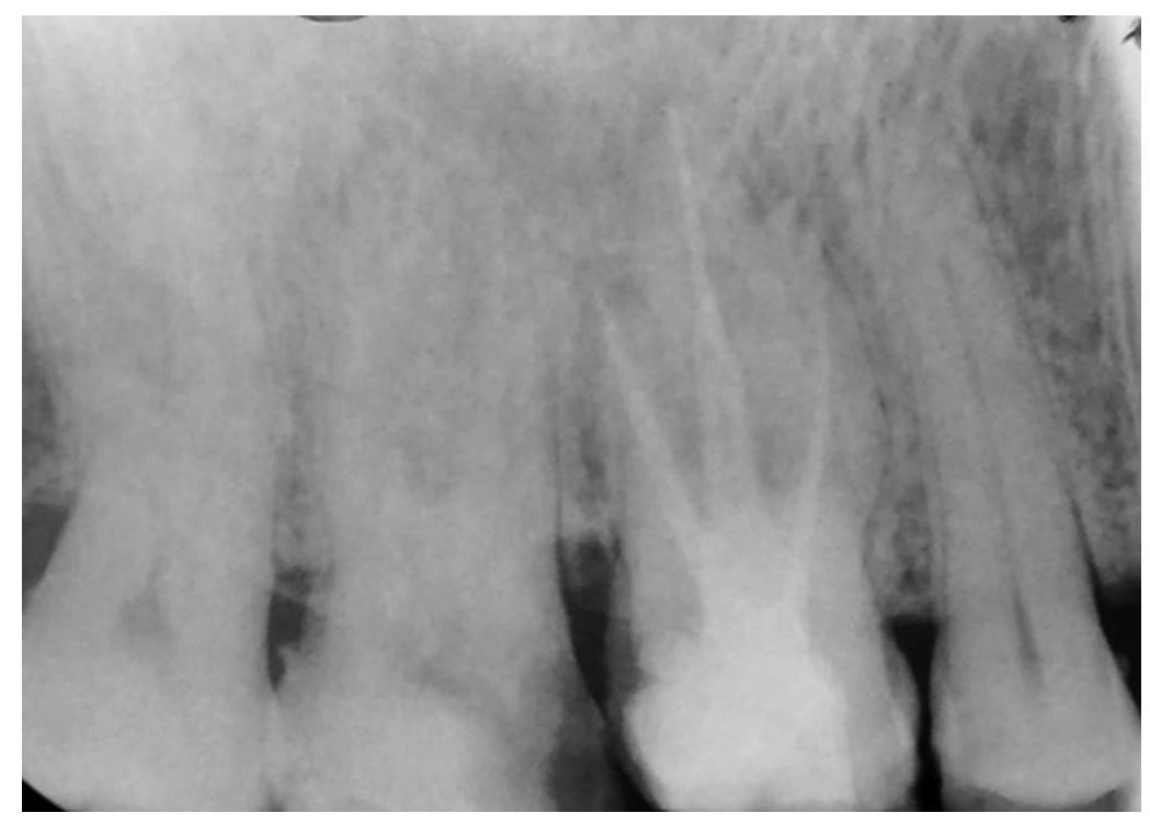 Preoperative intraoral periapical radiograph treated left