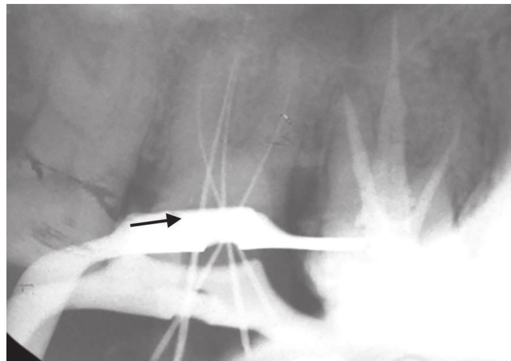 Intraoral periapical radiograph of working length the root
