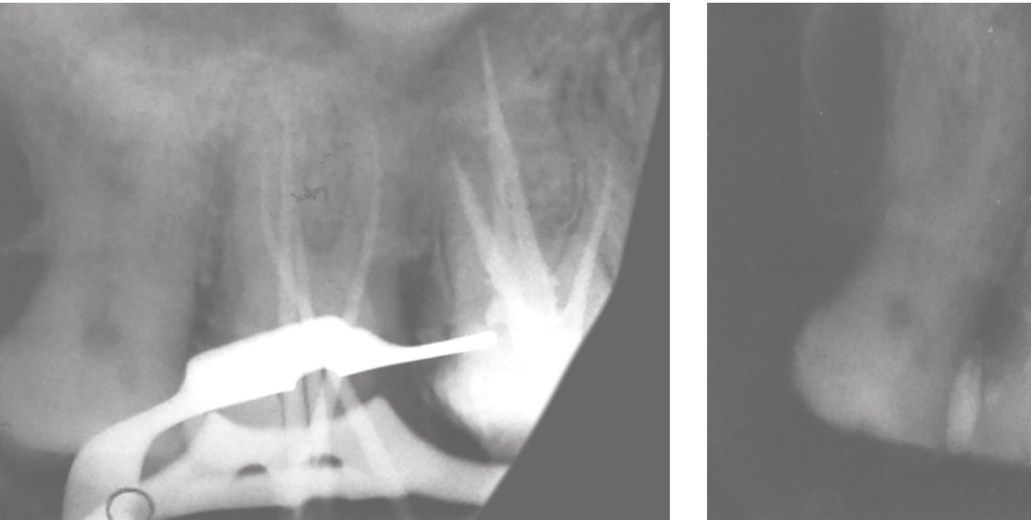Intraoral periapical radiograph of obturation fig. 4: