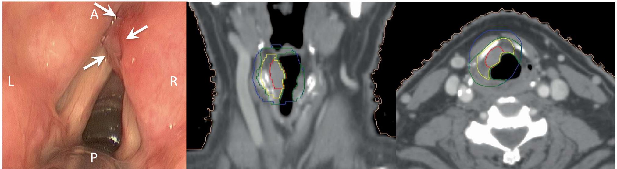 Endoscopic view (left), and planning ct on coronal (middle)
