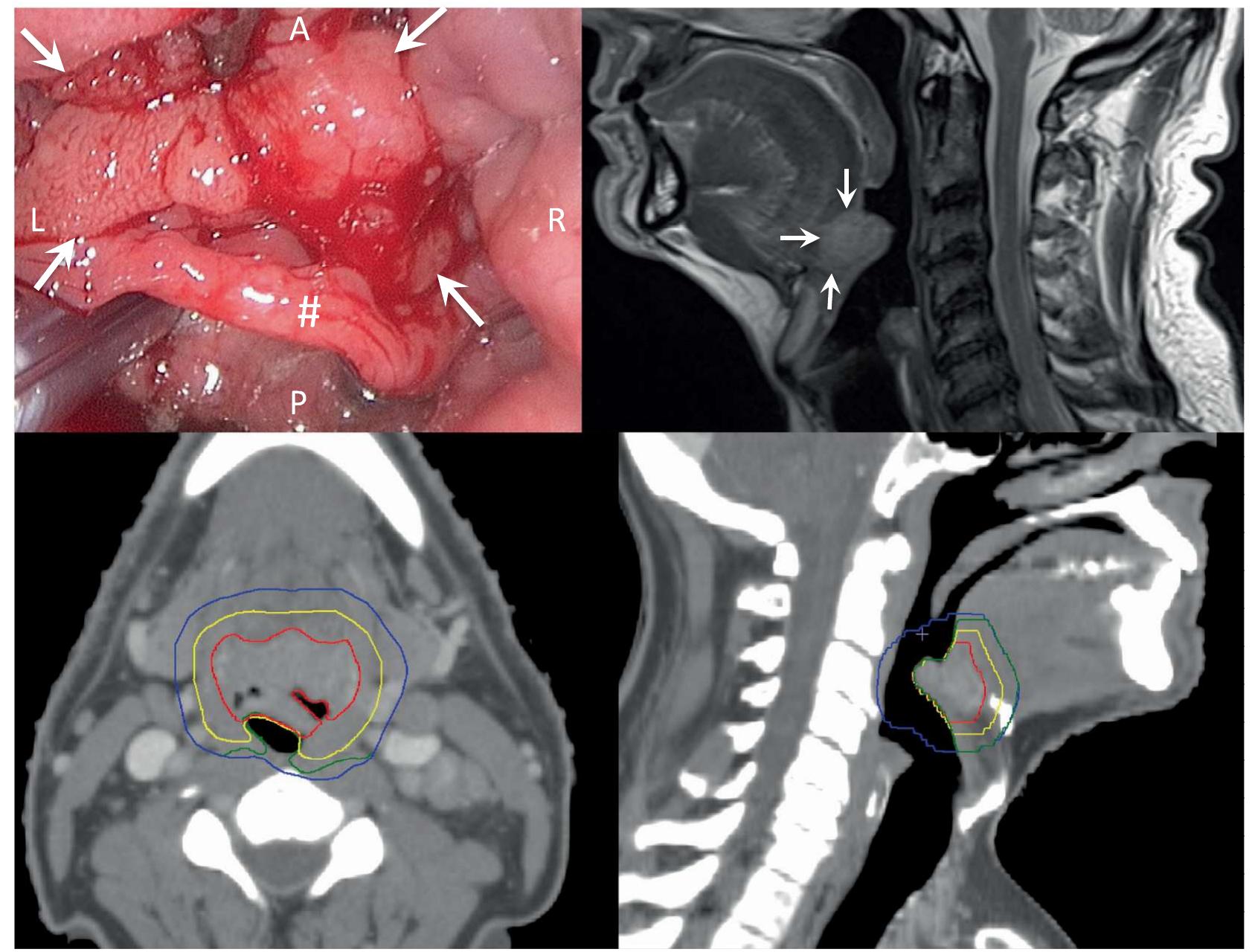 Endoscopic view (upper left), diagnostic sagittal mri t2